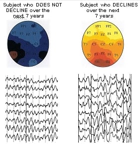 Diagnostik: Alzheimer-Frühdiagnose durch EEG und PET? - Spektrum der ...